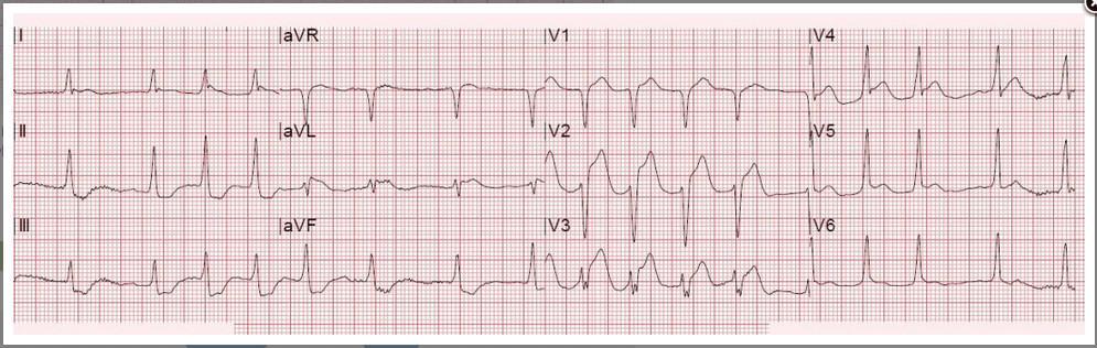 Test Your 12-Lead ECG Knowledge - Limmer Education